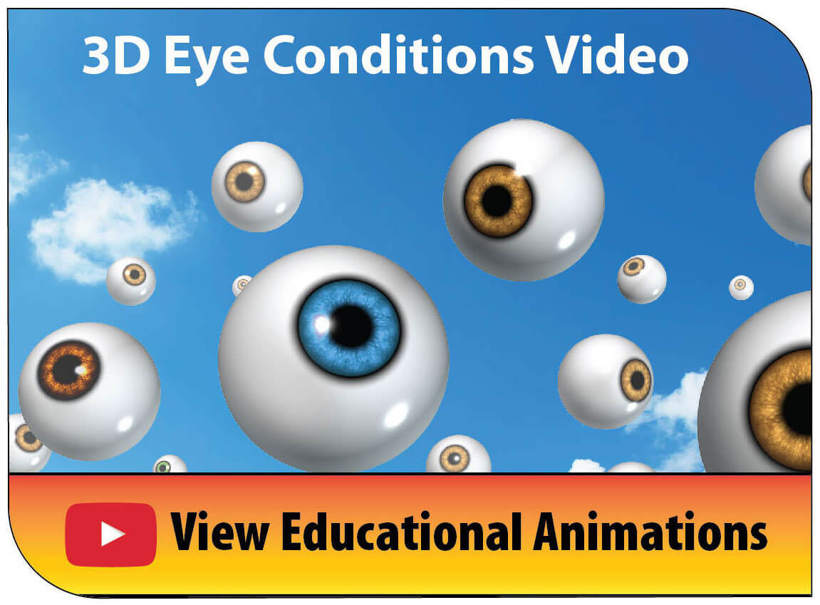 Eye Care Videos | Eye Doctors Sarasota | The Eye Associates